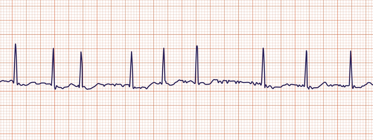 Triggers of atrial fibrillation Mnemonic [Easy to remember ...