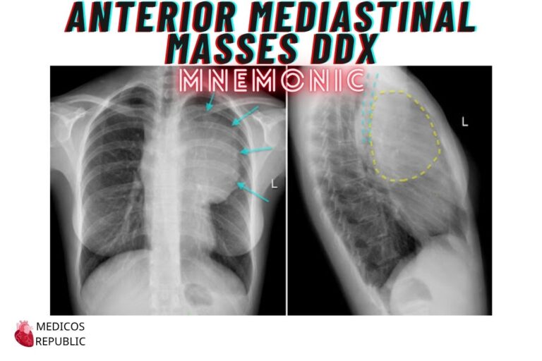 Anterior Mediastinal Masses DDx Mnemonic - "4 T's'